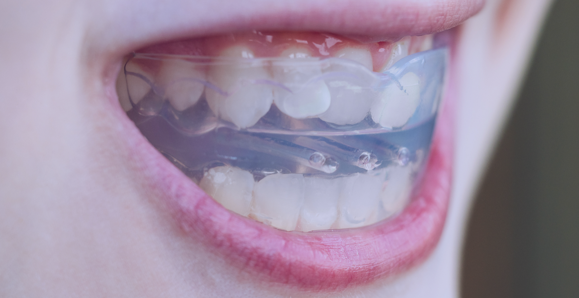 Unlock Your Best Smile: With Invisalign for Misaligned Teeth